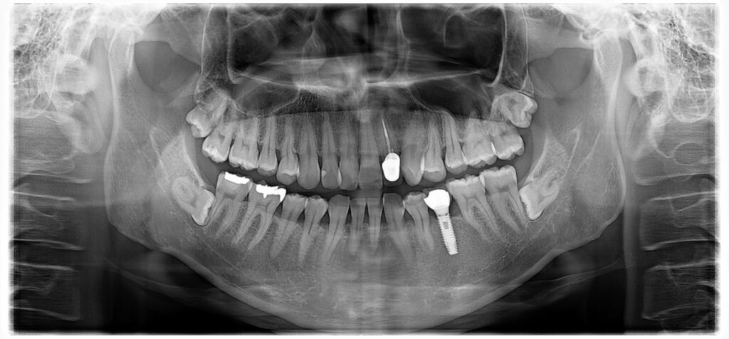 Rayscan Alpha - F1 Dentalsysteme