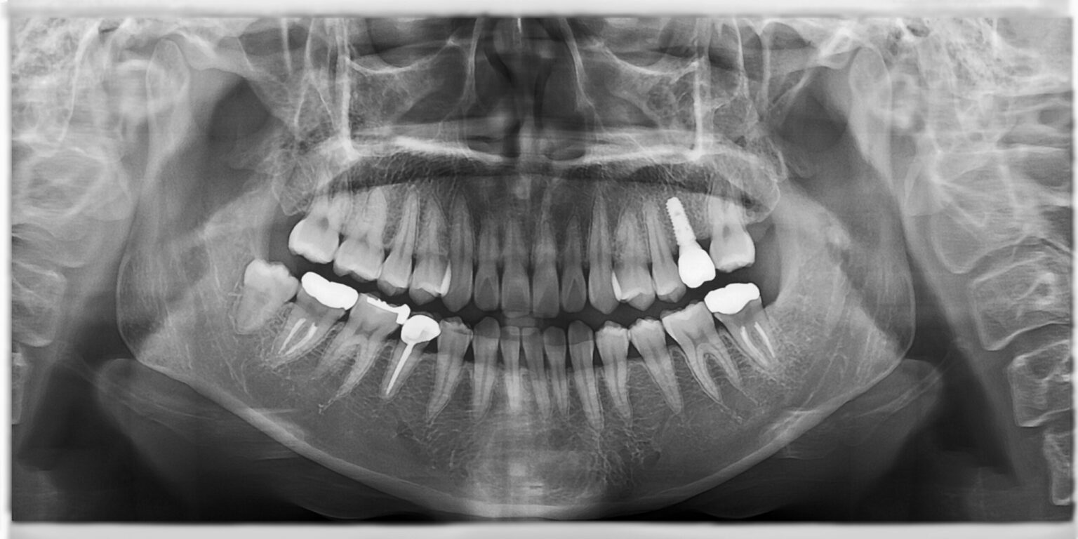 Rayscan Alpha - F1 Dentalsysteme